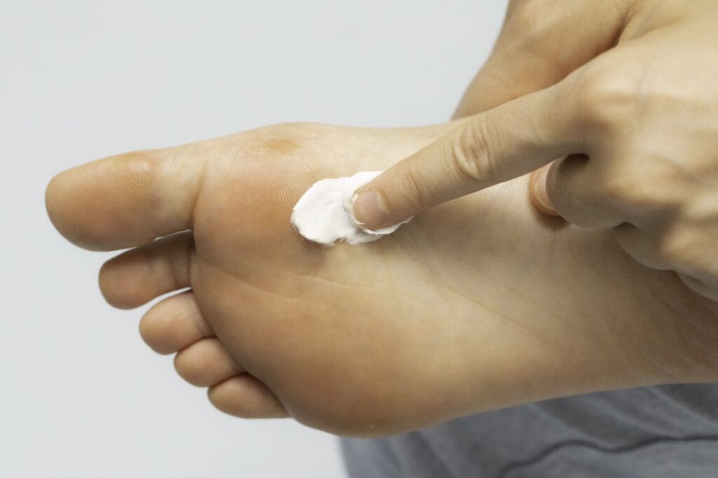 Ampollas en los pies: causas, prevención y tratamiento - MGC Mutua